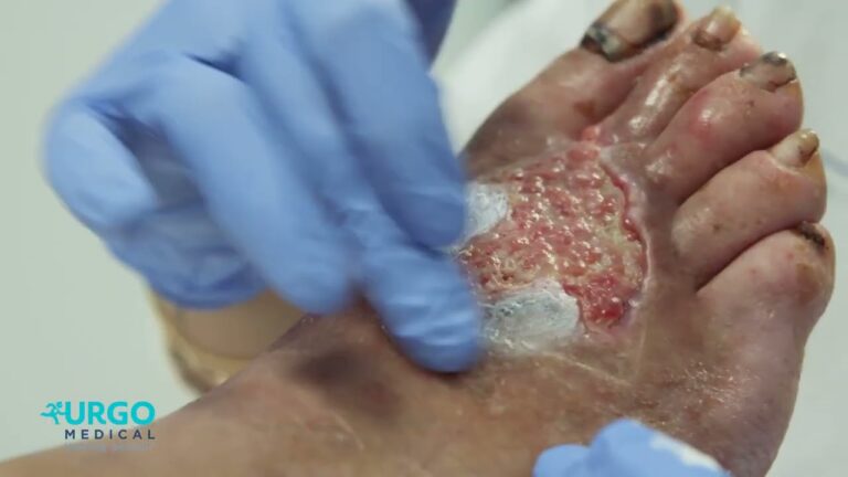 Todo lo que necesitas saber sobre el corte en el empeine del pie ...