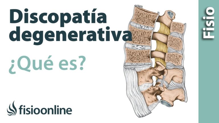 ¿Qué es la Discopatía Degenerativa L5-S1? Causas, Síntomas y ...