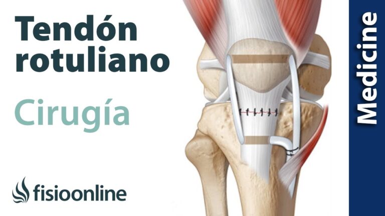 Tiempo de Baja Tras una Rotura del Tendón Rotuliano: Guía Completa para ...